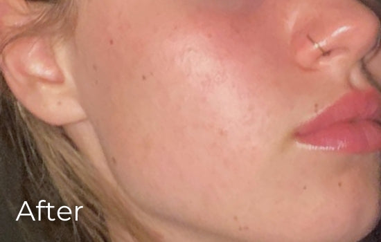 Hyclo Skin - Revolutionary HOCI Formula – Hycloskin