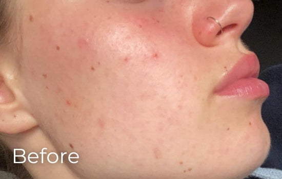 Hyclo Skin - Revolutionary HOCI Formula – Hycloskin